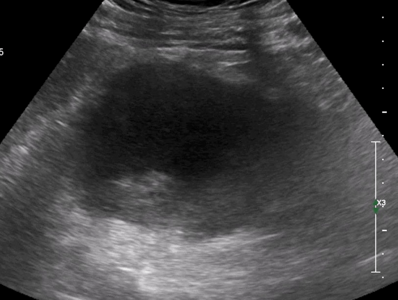 23 Principales síntomas de la prostatitis: signos frecuentes de ...